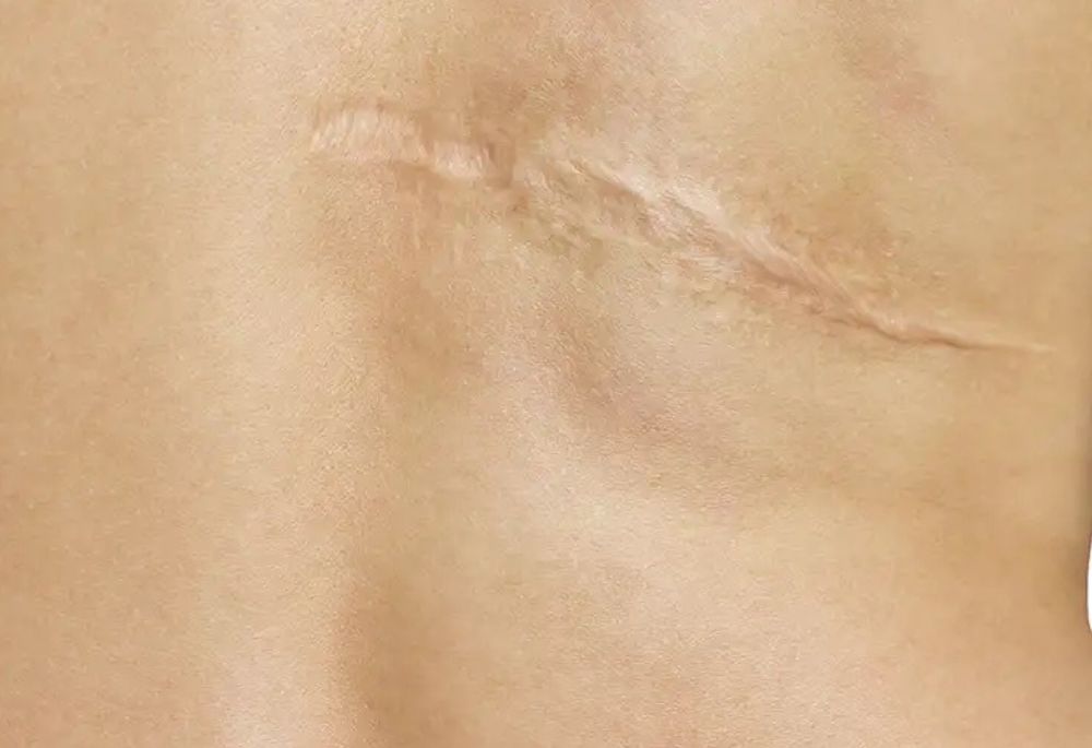 What Qualifies as a Disfiguring Injury? | Wagner Reese, LLP